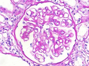 Kidney Involvement - Vasculitis Foundation