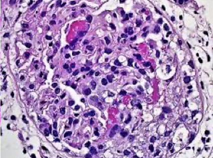 Kidney Involvement - Vasculitis Foundation